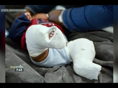 Learning in depth about clubfoot on World Clubfoot Day