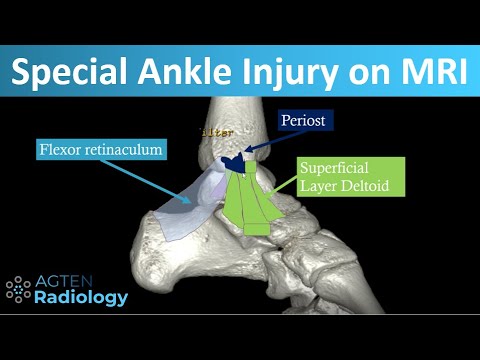 Deltoid Ligament Tear on MRI