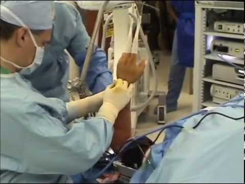 Arthroscopically Assisited Fixation and Percutaneous Grafting of Scaphoid Nonunions