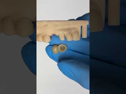 Zen Enamel Cantilever Bridge @EnvisiontecMain #envisiontec #lsk121shorts #dentist #teeth
