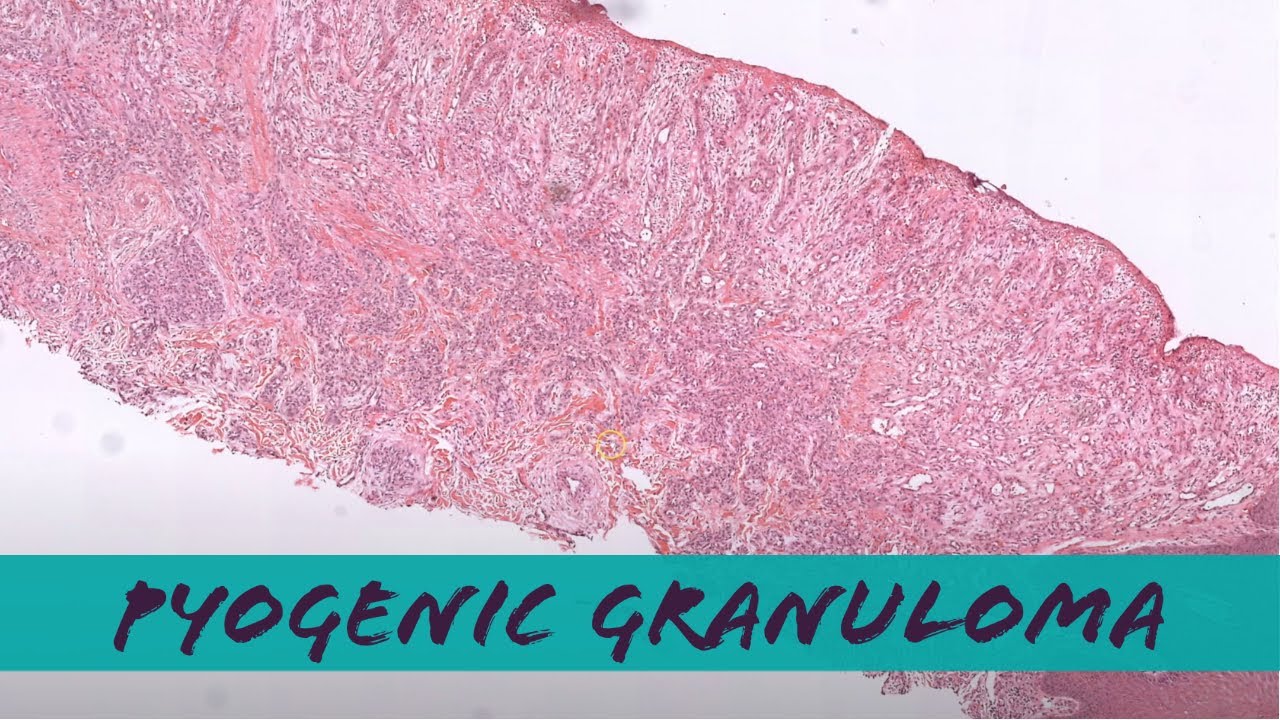 Pyogenic granuloma under the microscope (lobular capillary hemangioma) pathology dermatology