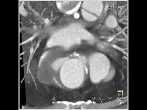 Cardiac: Pseudoaneurysm of aortic root (4 of 4)