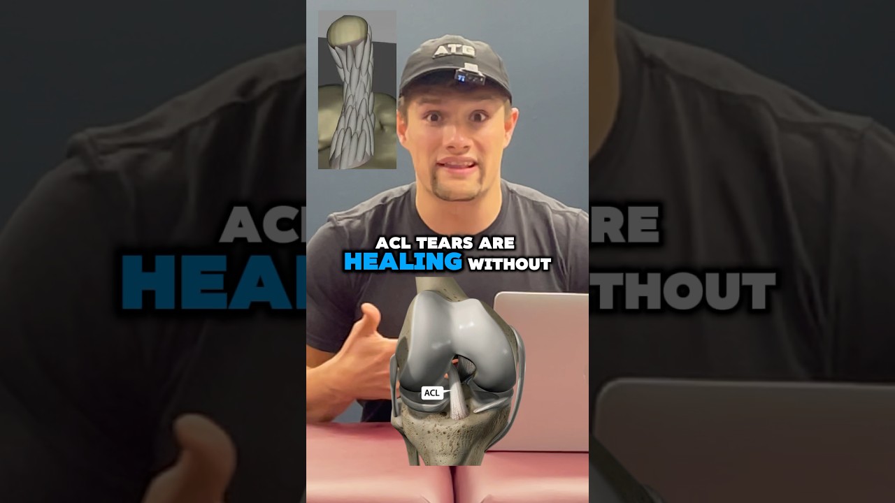 ACL TEARS ARE HEALING WITHOUT SURGERY?! #aclrecovery #kneeinjury #sports #orthoconcepts #aclrehab