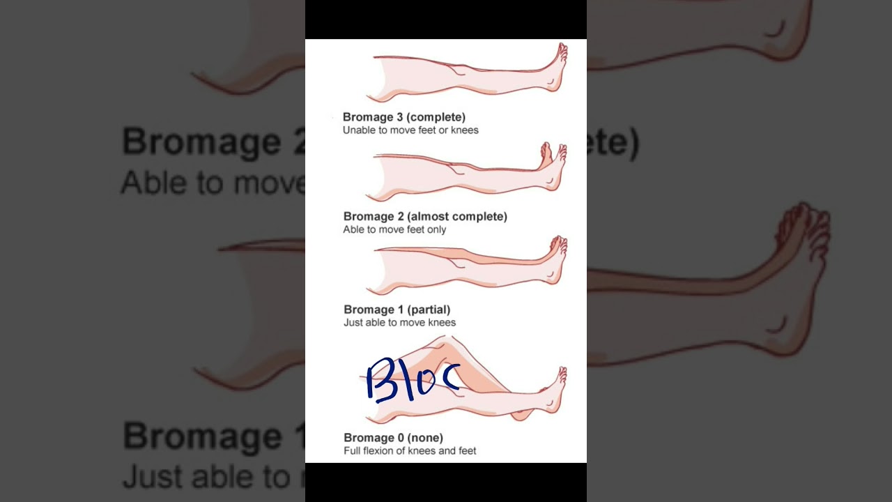 Bromage Score || #Anesthesia #painmanagement #shoreyoutube #viral #video #medical