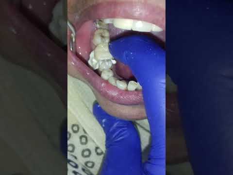 Zirconia crown to protect root canal treated teeth #shorts #satisfying #dental#dentist