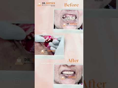 Laser Gum Surgery | Dr Gupta's Dental Clinic