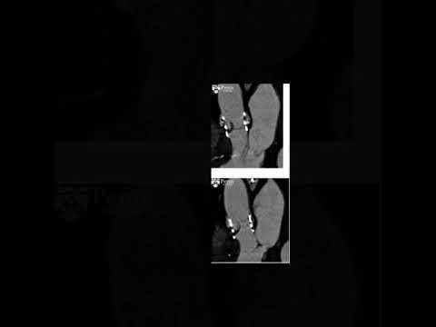 Hypoattenuated leaflet thickening (HALT)