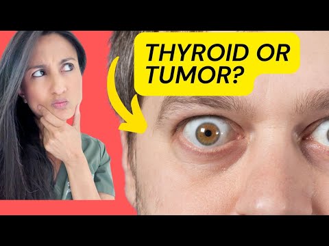 Warning: Bulging Eyes Are Not Normal | What causes bulging eyes | Thyroid eye disease | Eye tumor