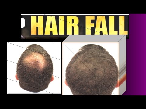 Minoxidil|| finasteride||Minoxidil hair regrowth results||