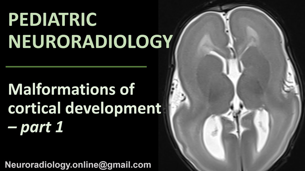 Understanding Malformations of Cortical Development in Pediatric ...