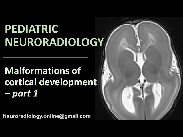 Understanding Malformations of Cortical Development in Pediatric ...