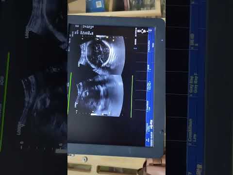 Obstetrical ultrasound, AC measurement on ultrasound urdu/hindi