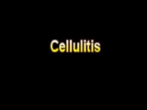 What Is The Definition Of Cellulitis Medical Dictionary Free Online