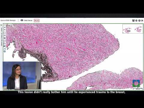 Mammary Myofibroblastoma: A Practical Approach to Pathologic Diagnosis on Core Needle Biopsy