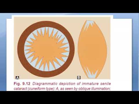 Ophthalmology 193 Cortical Senile Cataract Incipient Immature Mature HyperMature Morgagnian Soft