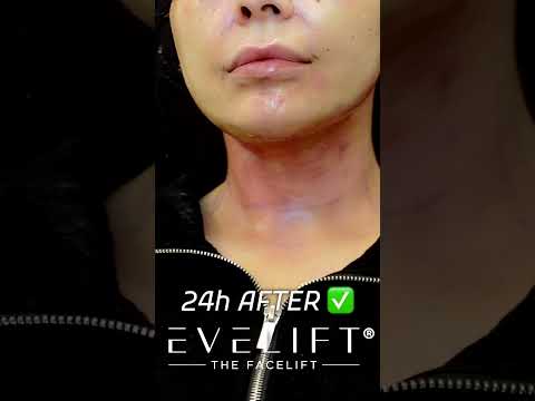 Patient Neck Before And 24 Hours After EVE Lift™ | Eden Plastic Surgery: Dr. Ali Charafeddine, MD