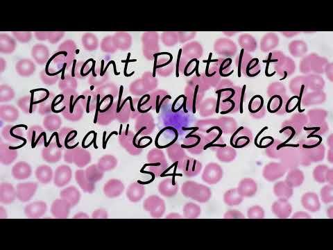How to pronounce Giant Platelet, Peripheral Blood Smear"6032662354" in English?