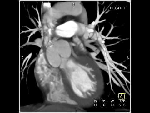 Cardiac: Marfan's Syndrome (2 of 7)