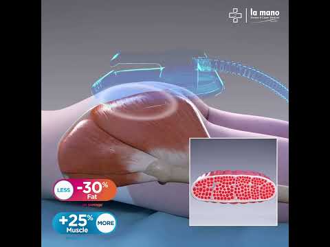 ππ π¦ππ¨ππ£π§ π‘ππ’ non-invasive body shaping procedure.