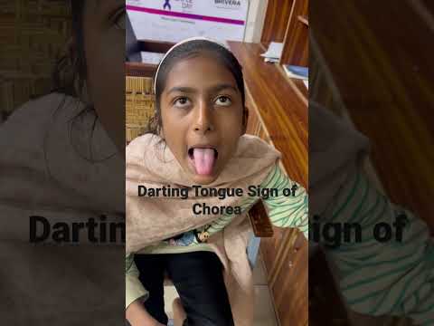 Darting Tongue Sign of Chorea #Rheumatic #Chorea #shorts #neurology #sydenham ðŸ§