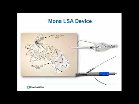 10.40-10.50: Tips and Tricks of Branched Left Subclavian Stent Grafts, Eric E. Roselli, MD
