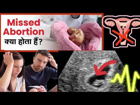 Missed Abortion क्या होता हैं? | Missed Abortion - Causes, Symptoms & Diagnosis #missedabortion