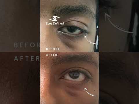 ✨ Ptosis Surgery with Mucosal Grafts – Before & After ✨