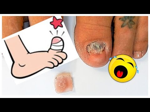 I STUBBED My Toe & KNOCKED OFF My FAKE Toe Nail -- BAD BRUISING ! -- OUCH !