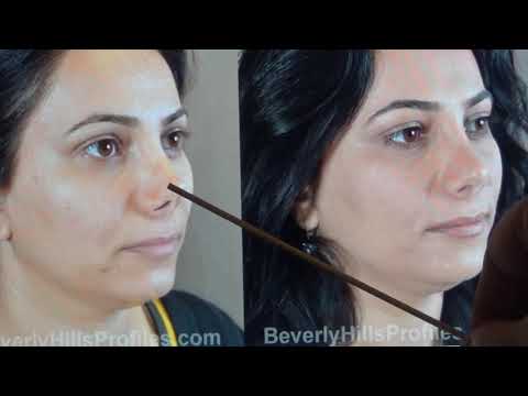 Patient Underwent Revision Rhinoplasty | Beverly Hills Profiles
