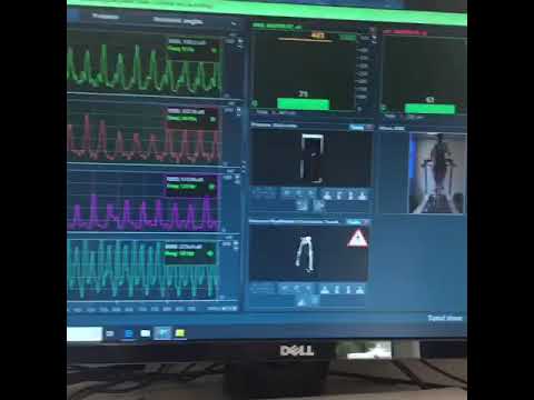 Instrumented treadmill analysis