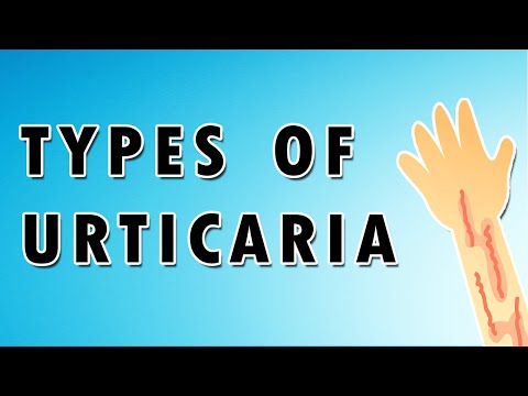 Urticaria Symptoms, Treatment, and Causes