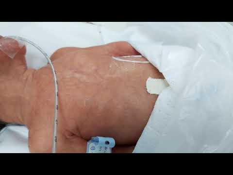 case 423 prematurity with mottling skin, cutis marmarota,hypoperfusion, hypothermia, sepsis CRT,UOP