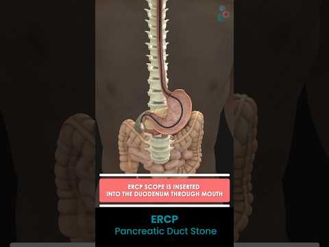 ERCP - Pancreatic Ductal Stone Removal ↪ 3D Medical Animation #Shorts #Pancreatic #Stone #ERCP