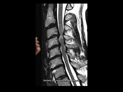 Cervical Spondylosis MRI Analysis #shorts