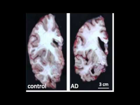 Alzheimer’s Disease