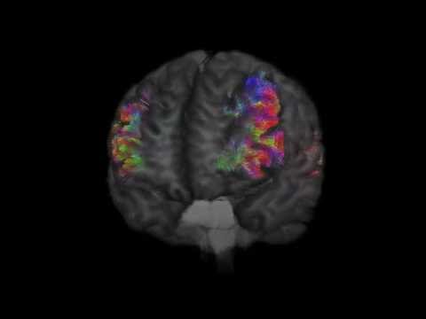 Arcuate Fasciculus