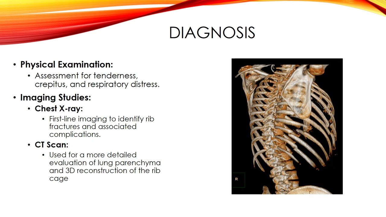 Fixing the fractured rib: current guidelines
