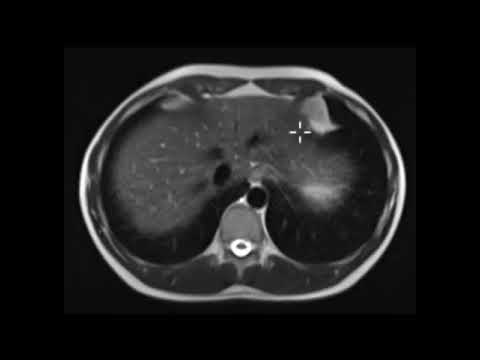 What does the liver look like on MRI?