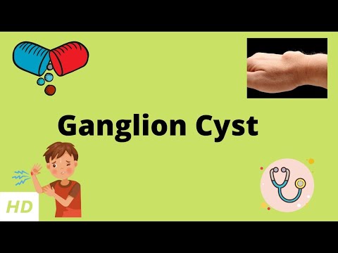 Ganglion Cyst, Causes, Sign and Symptoms, Diagnosis and Treatment.