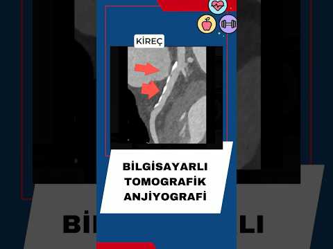 DAMARDAKİ 0,2 MİLİMETİRİK KİREÇ, SANAL ANJİYO, SERDAR AKGÜN