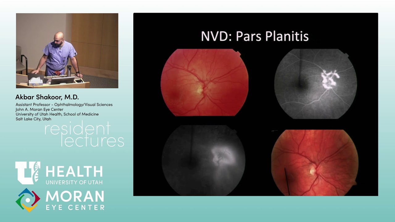 Intermediate Uveitis [ARCHIVE]