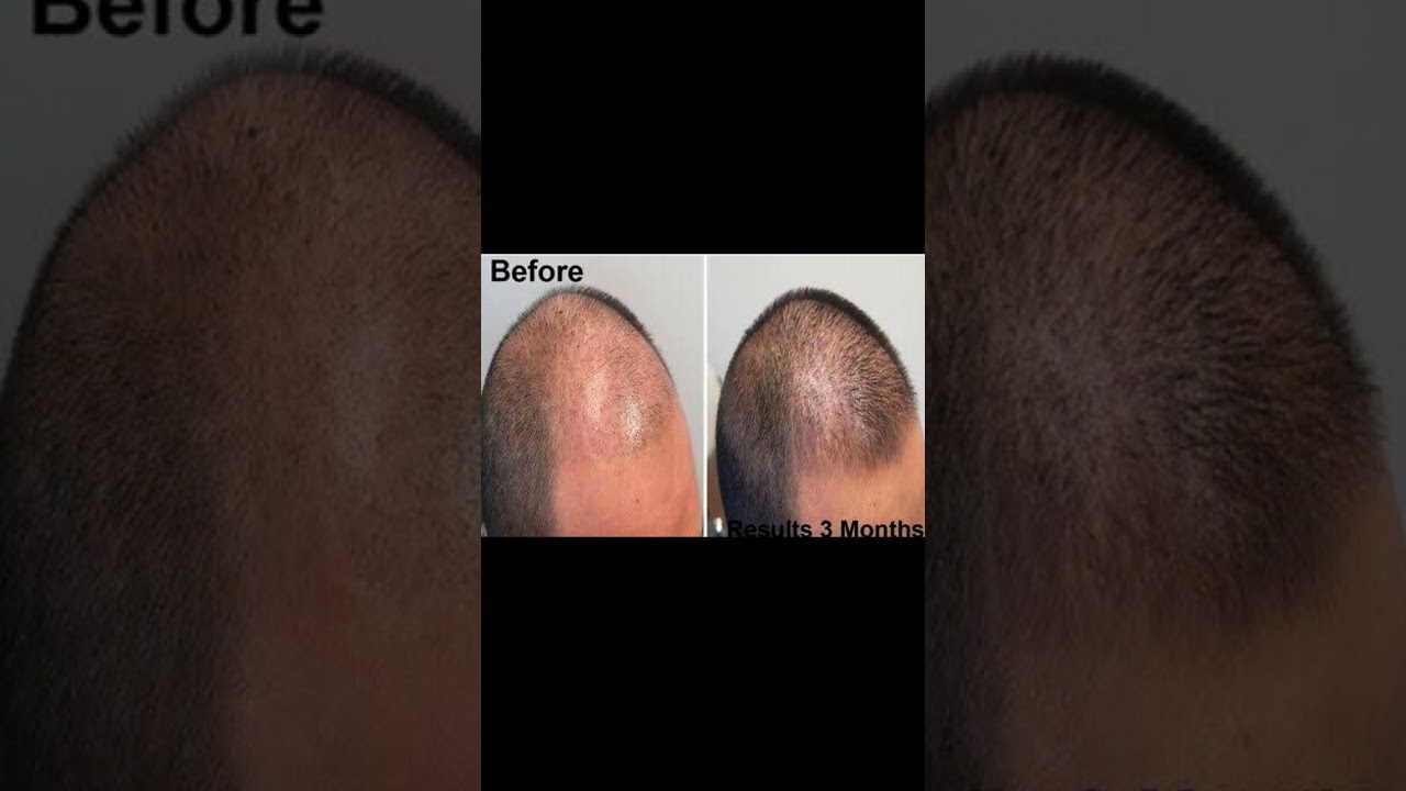 Regrowth and hair fall problems contact us! #dhchaircare #hair #regrowth #hairfall #hairsolution