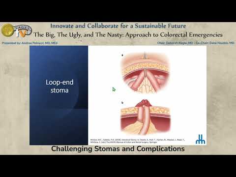 Challenging Stomas and Complications