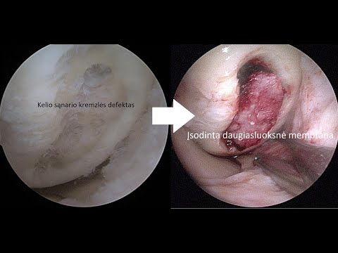 Knee joint, MaioRegen, Chondroplus scaffold implantation (medial femoral condyle) by R Gudas