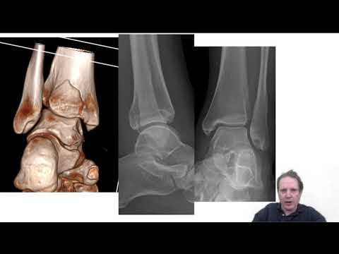 case takeaway - maisonneuve ankle fracture and medial deltoid ligament injury - Lyndon Mason