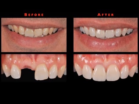 Dental implants at the University of Iowa College of Dentistry & Dental Clinics