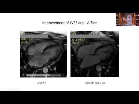 The Convergent Procedure is the Best Option