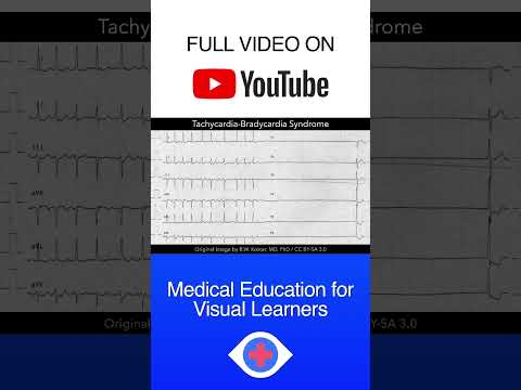Tachycardia-bradycardia syndrome ECG #shorts