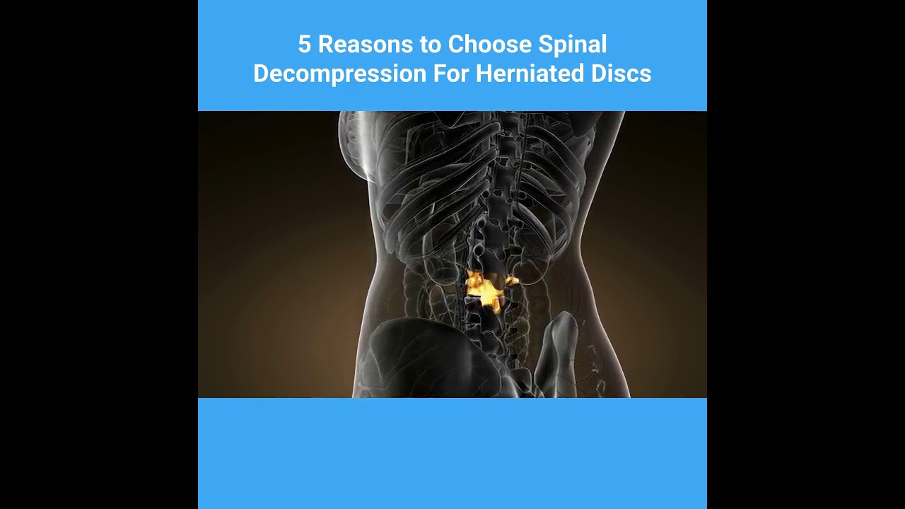 5 reasons to choose spinal decompression for herniated discs 1