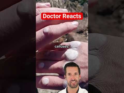 ER Doctor REACTS to World's Largest Hand Callus
